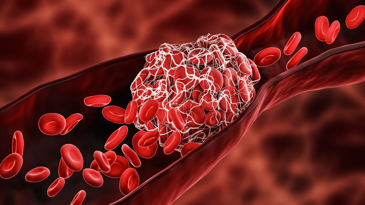 Akura Medical secures $35M to pursue FDA clearance for thrombectomy ...