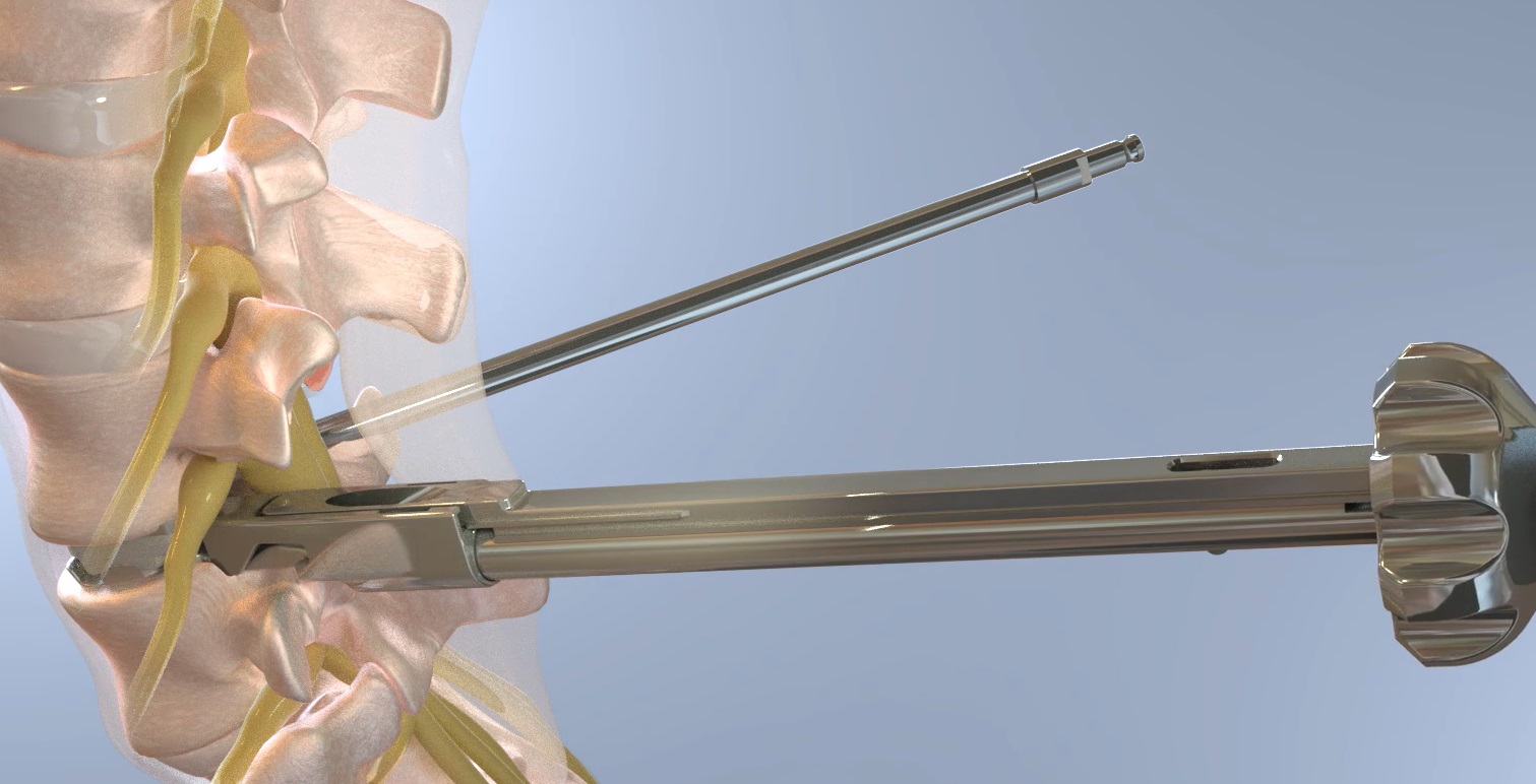 3Spine Announces Completion of FDA Clinical Trial Enrollment Achieving ...