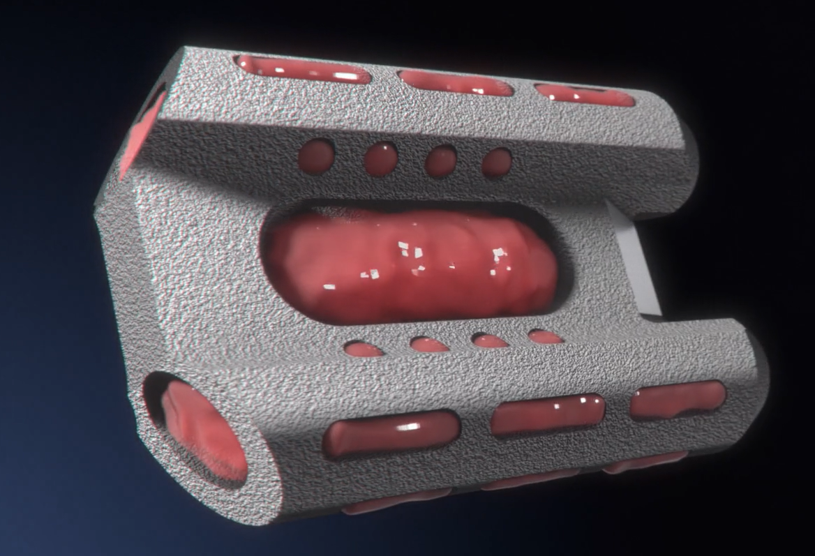 Tenon Medical, Inc. Announces Issuance of Notice of Allowance of Patent ...