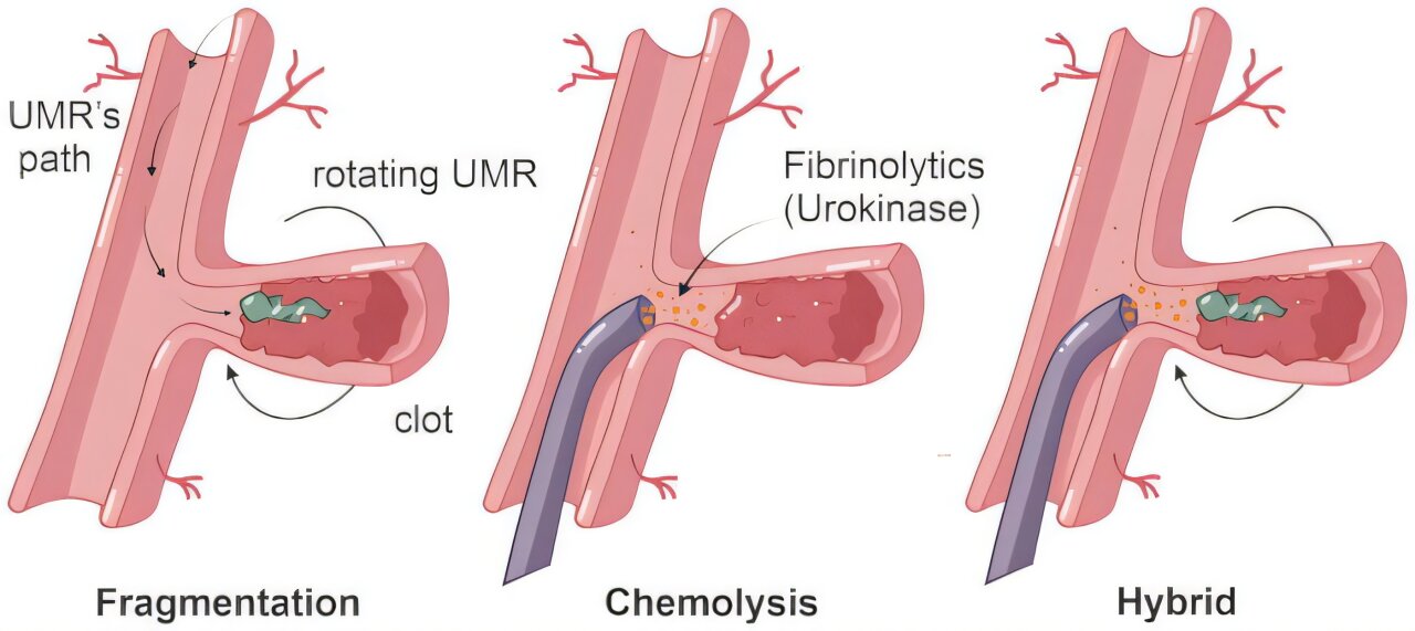 Magnetic microrobots remove blood clots from sheep iliac artery – Start ...
