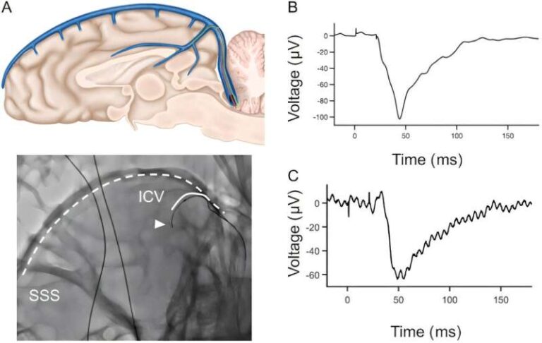 Brain Blood Monitoring - Start Medical Product Development