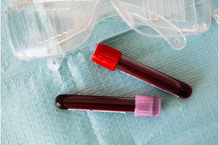 Blood test for strokes - Start Medical Product Development